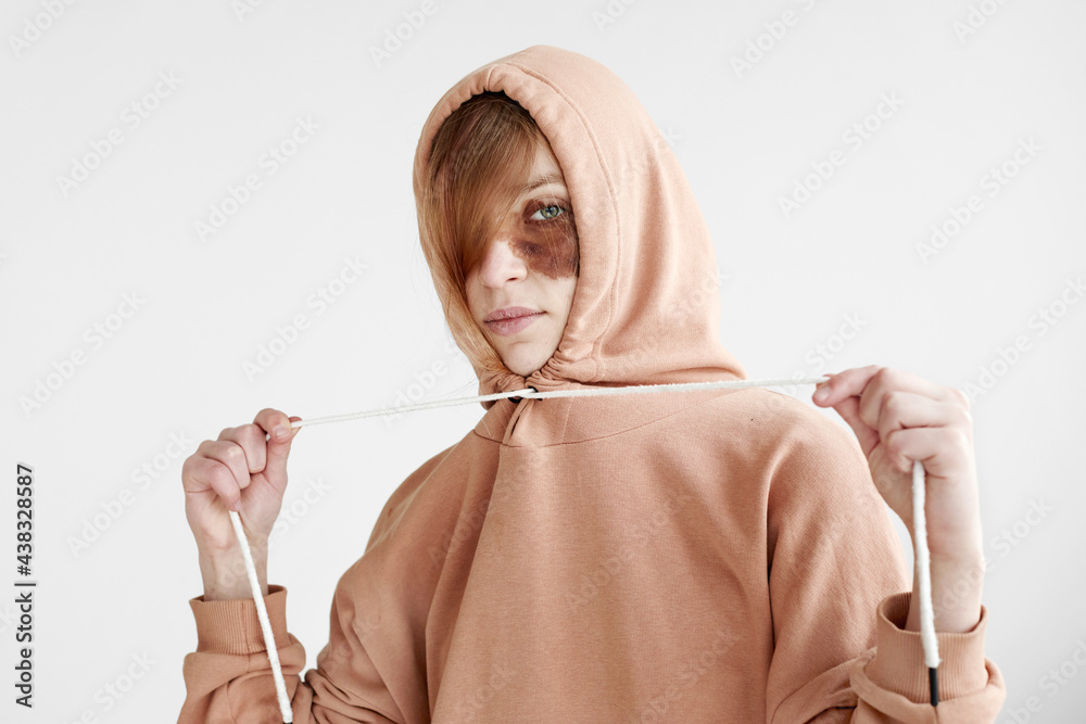 Young female model with large brown hyperpigmentation spot on face ...