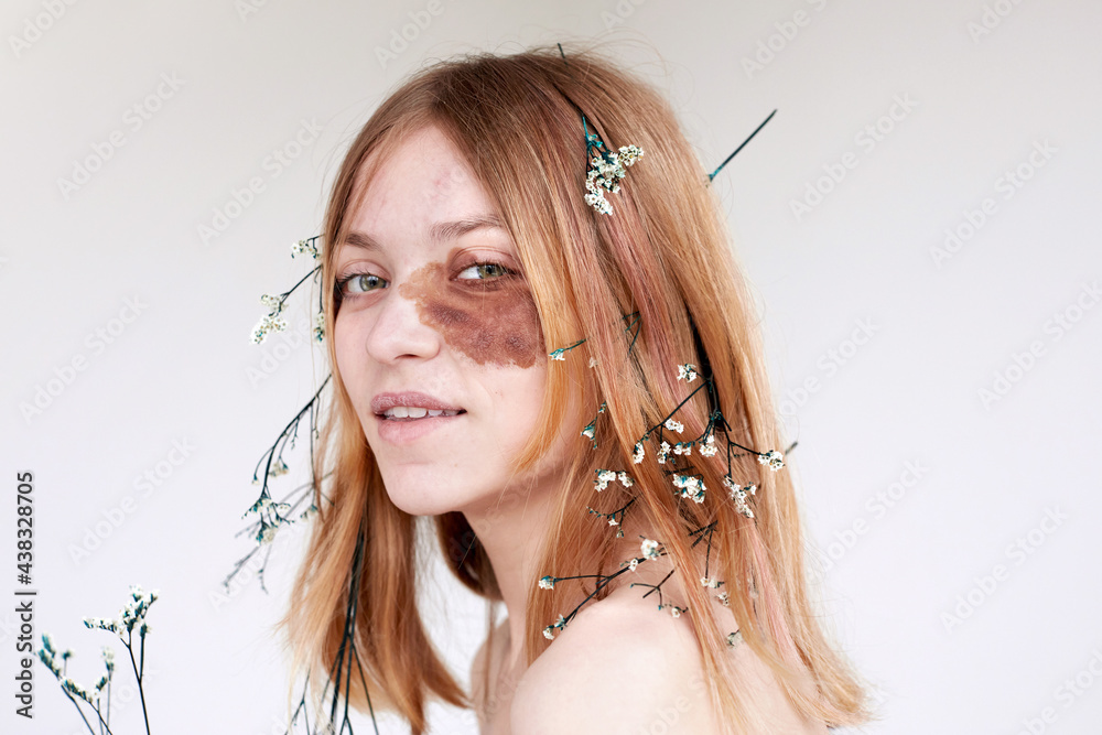 Positive young female model with brown spot on face skin and delicate ...