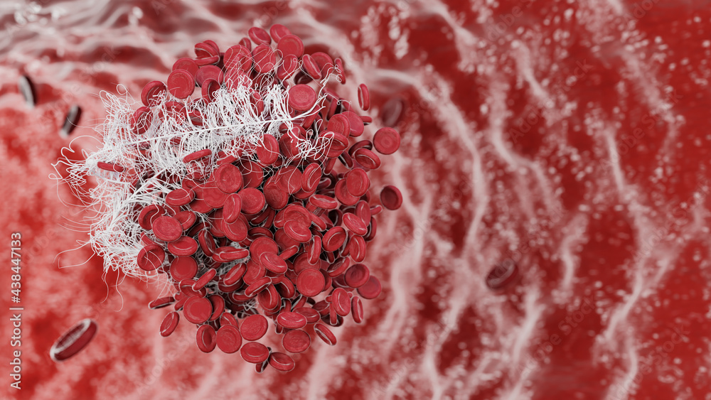 Aggregation blood cells. blood clot, Thrombus, embolus, Coagulated red ...