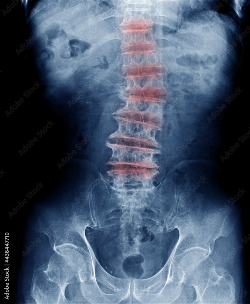 thoracic and lumbar degenerative change x-ray image, back pain in old ...
