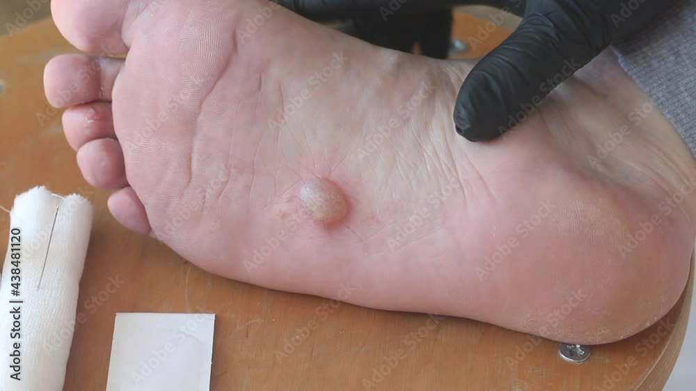 Dyshidrotic eczema on the foot, dermatitis. Nearby is a bandage and a ...