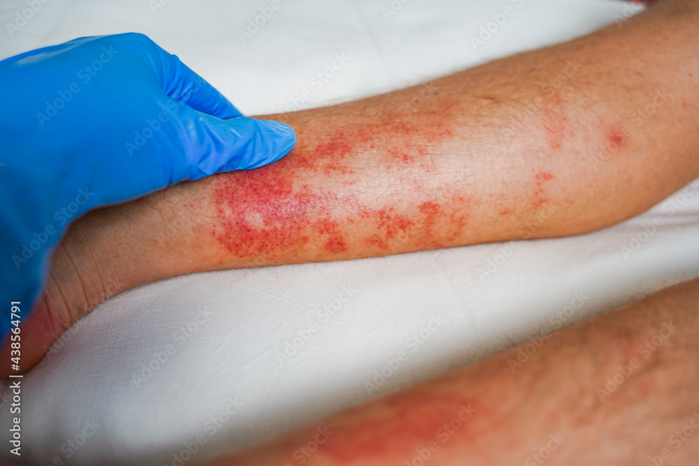 Eczema Skin disease on the legs, itchy red rashes and spots Stock Photo ...