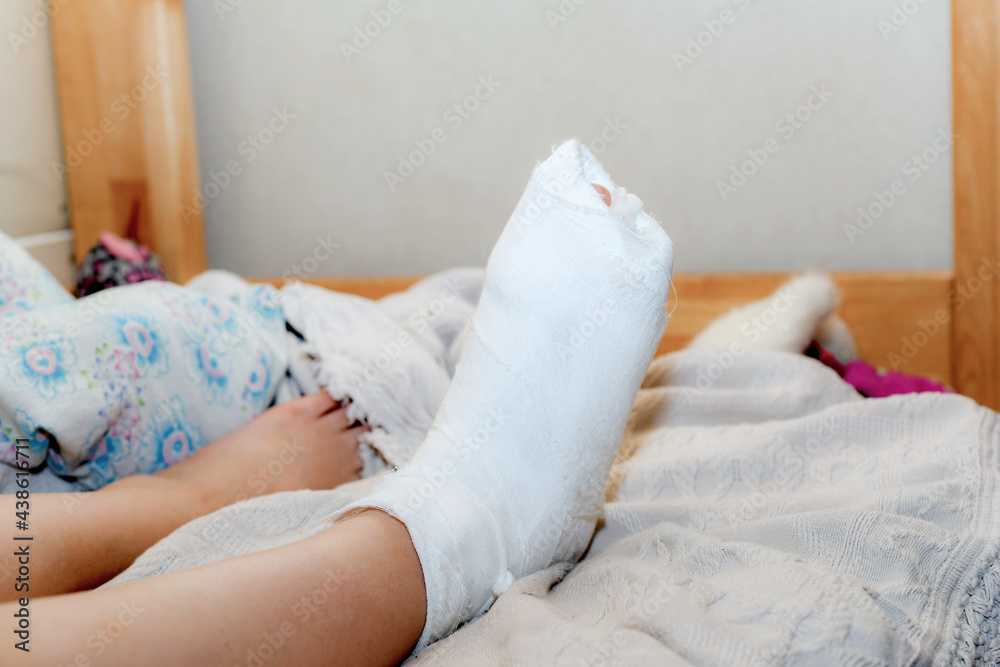The girl has a broken leg. Woman resting at home in bed after medical ...