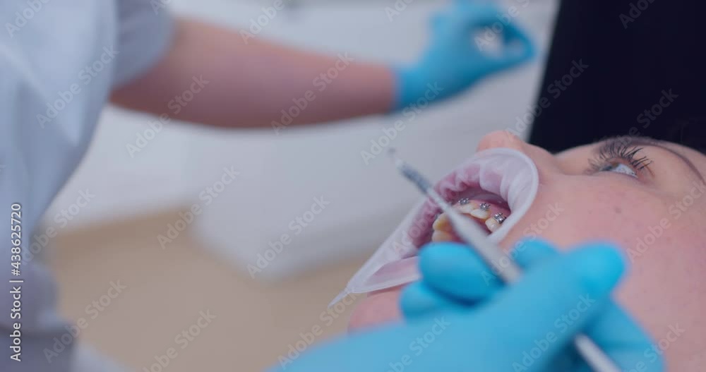 Close-up open mouth with optragate of a female patient and on the teeth ...