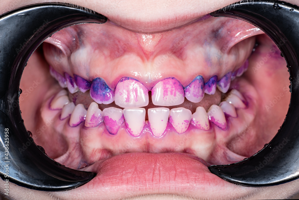 Colored plaque on a child's teeth close-up.Front view of human teeth ...