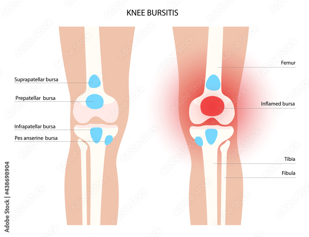 Prepatellar Bursitis
