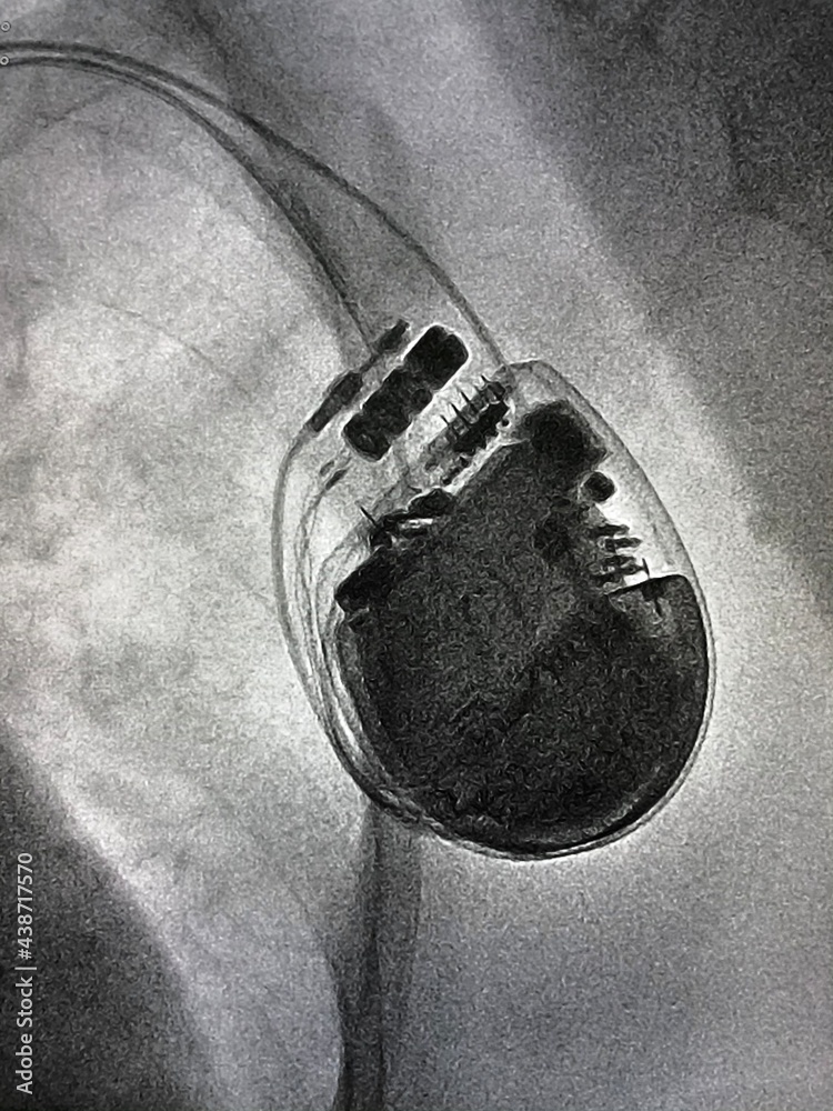 X ray image during permanent pacemaker implantation procedure. Stock ...