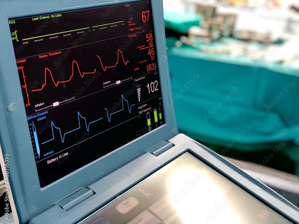 Intra aortic balloon pump (IABP) machine in operating room. Stock Photo ...