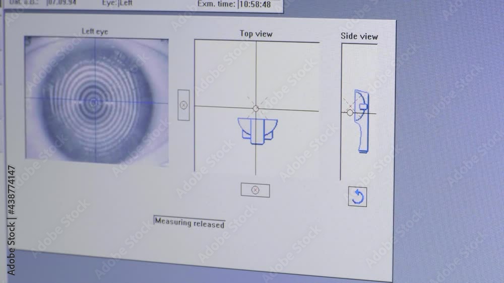 Screen view digital biometrics and tomography of the eye during medical ...