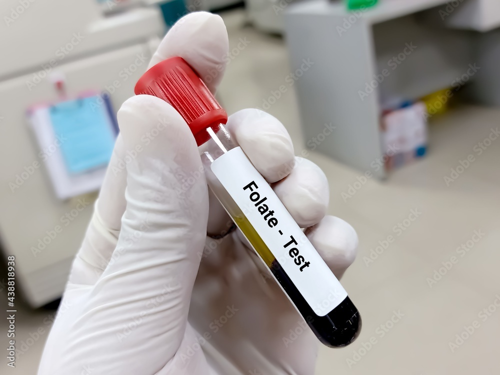 Foto de Blood sample for Folate test, iron deficiency anemia. A medical ...