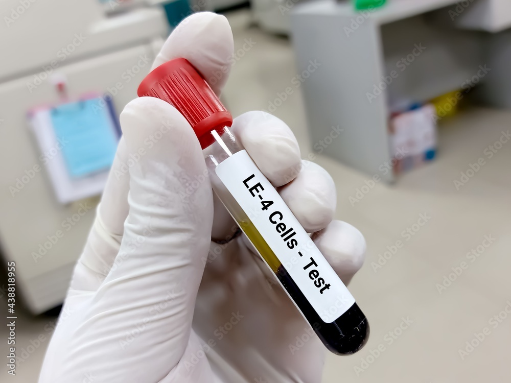 Blood sample for LE-4 cells test, lupus erythematosus. A medical ...