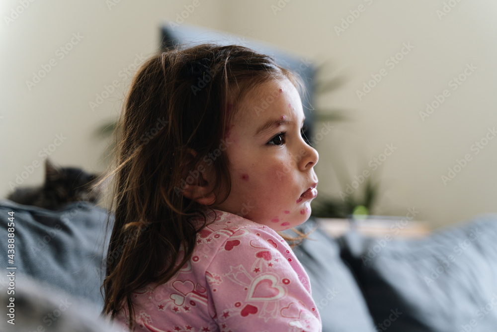 Toddler girl with chickenpox measles on the body. Varicella virus ...