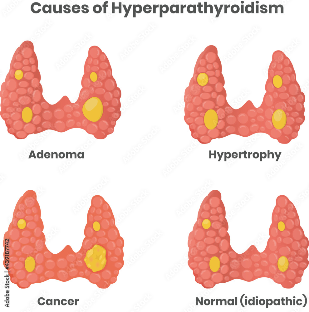Hyperparathyroidism causes illustration. Adenoma, cancer, enlargement ...