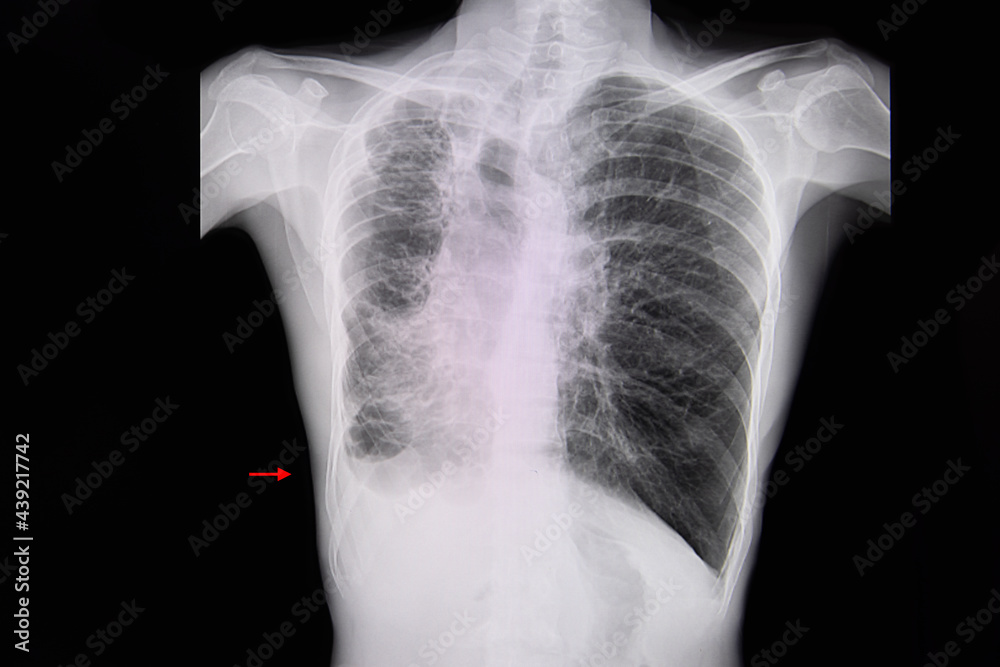 Bronchiectasis X Ray