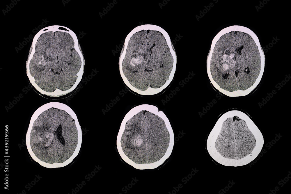 CT brain scan of the patient with basal ganglia hemorrhage. Stock Photo ...