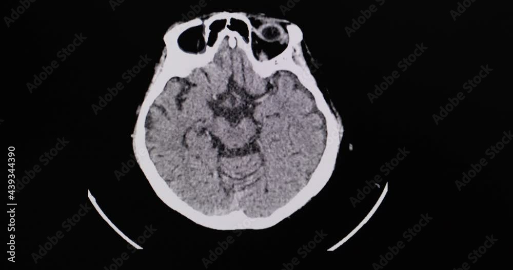 Vídeo do Stock: A CT scan of the brain of a patient subdural hematoma ...