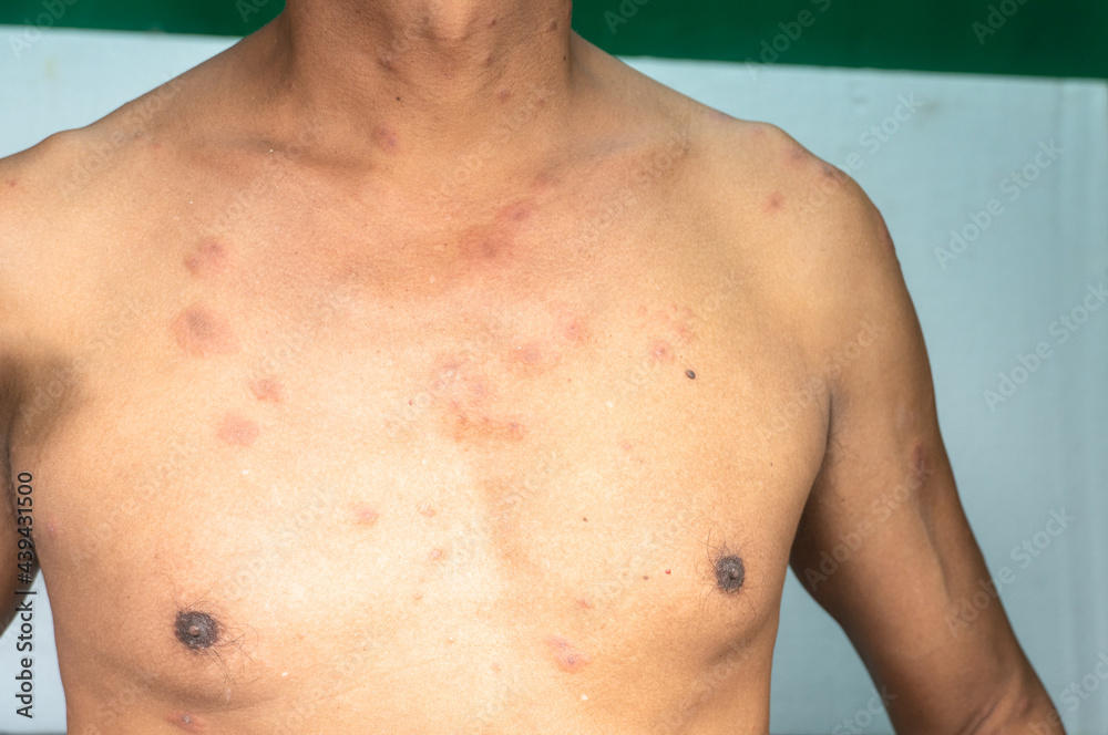 .A 60-year-old man has a blistering rash. There are lymphatic fluids ...