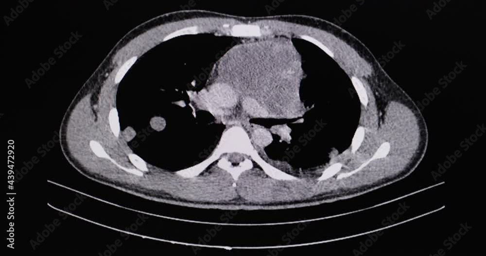 CT cine scan of the chest and abdomen of a patient with lymphoma ...