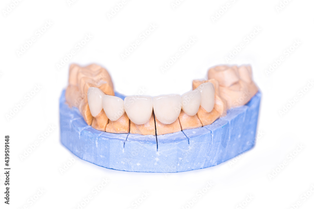 Veneers and crowns isolated on white background. Plaster model of teeth ...