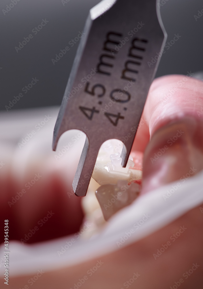 Dental height gauge. Macro photography. Vertical close-up snaphot of a ...