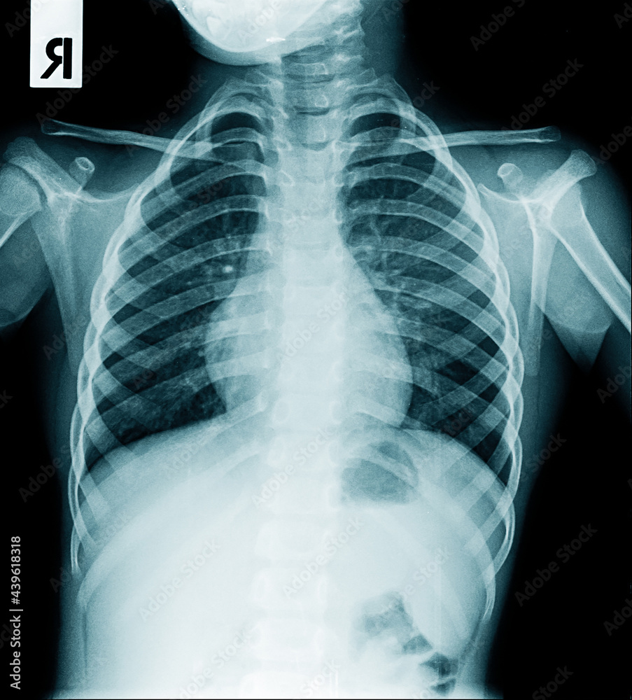 x-ray image of child lung and inside chest, chest x-ray image of child ...