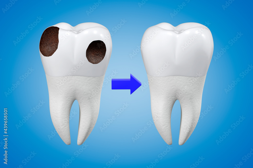 Carious tooth treatment concept. A tooth with decay and a healthy tooth ...
