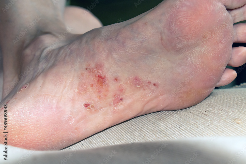 female foot with eczema, wound dermatitis, skin peeling Stock Photo ...