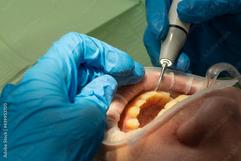 dentist holding a patient, tartar or calculus removal with ultrasonic ...