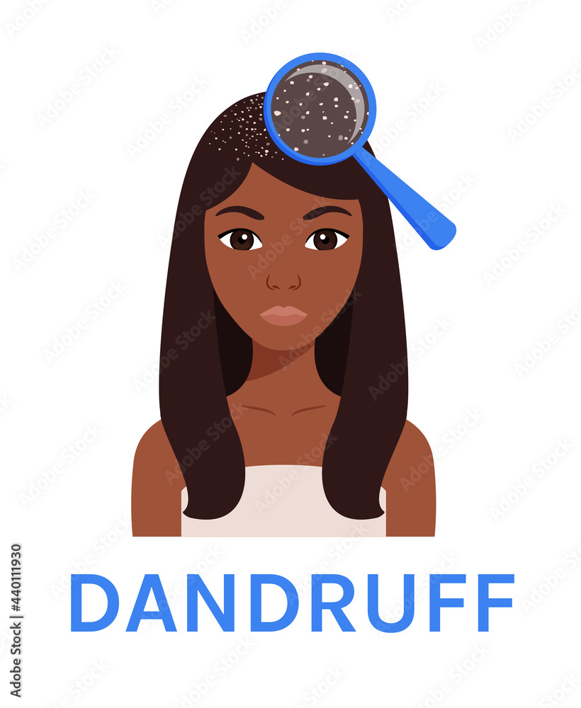 Pretty Afro Black Girl and Dandruff on her Head for medical design ...