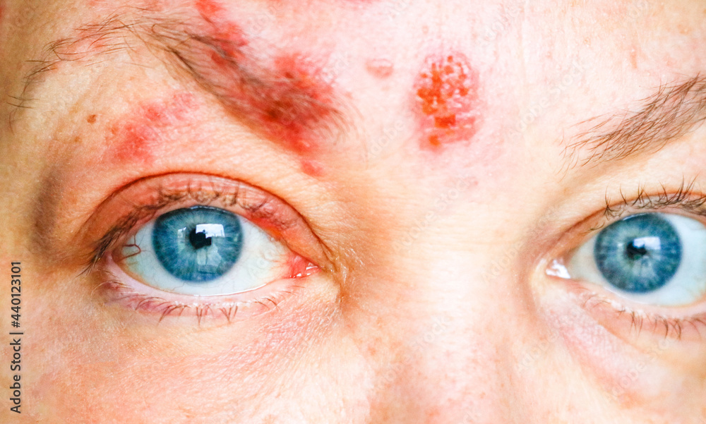Shingles on the Face and Around the Eye, Called ophthalmic herpes ...