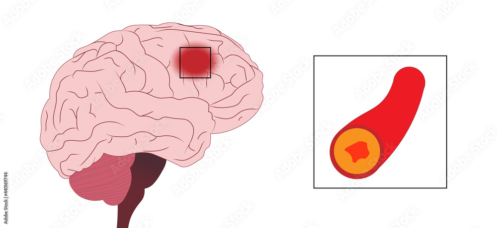 Brain Stroke illustration. Stroke in the frontal lobe of a brain ...