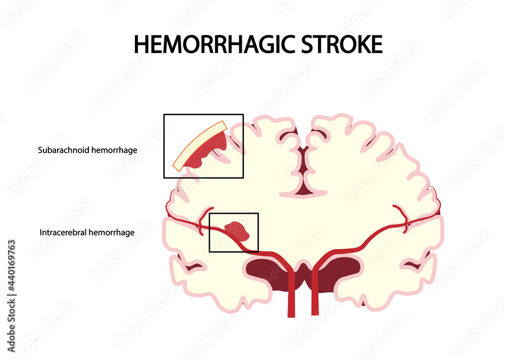 Hemorrhagic Stroke. Intracerebral hemorrhage and Subarachnoid ...