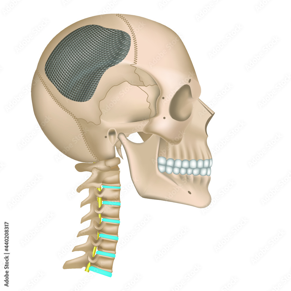 Cranioplasty of the skull. Operation to restore the bones of the head ...