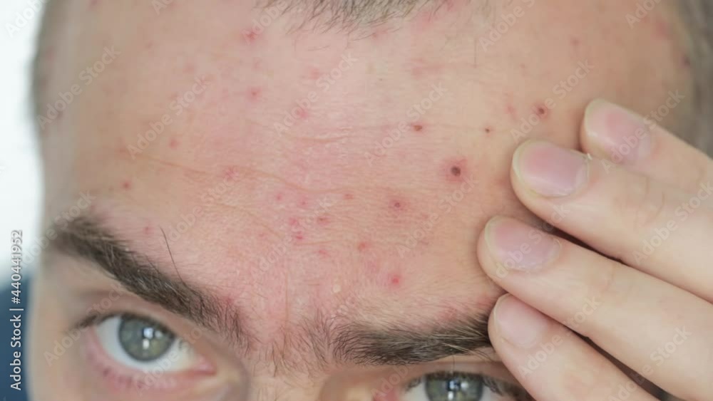 Body of adult man have spotted, red pimple and bubble rash from ...