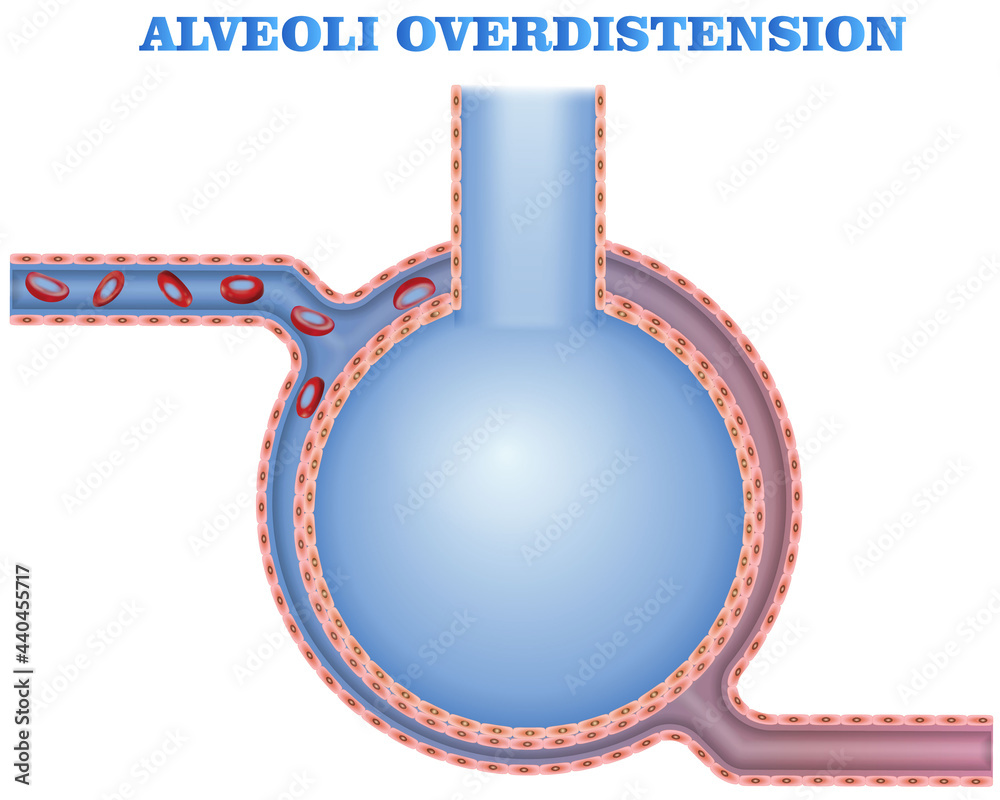 Alveoli overdistension during mechanical ventilation, ventilator ...