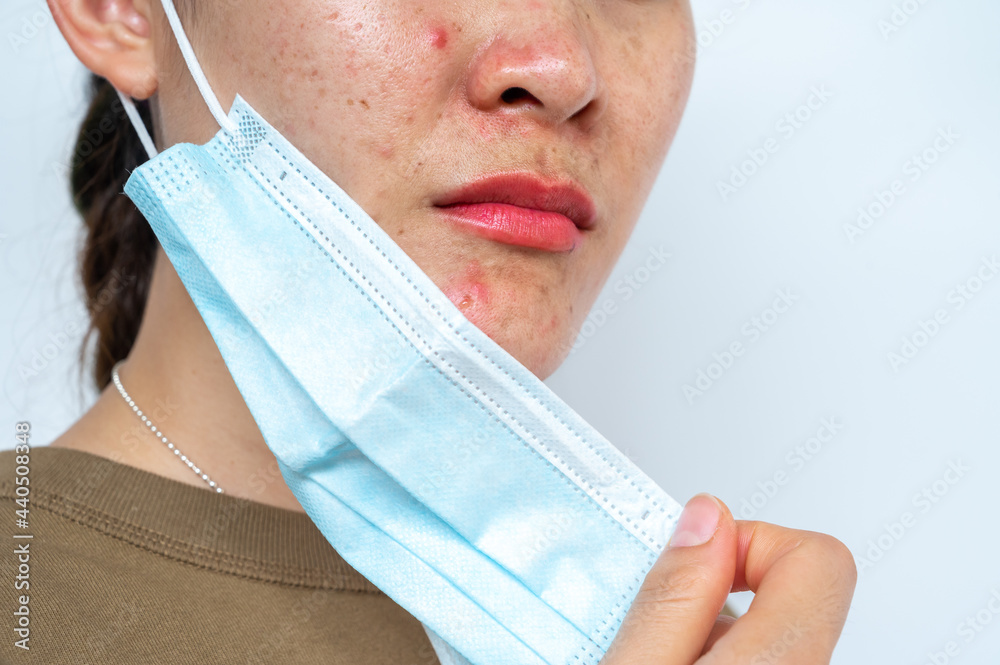 Headshot of acne Inflamed occur on woman skin after wearing a mask for ...