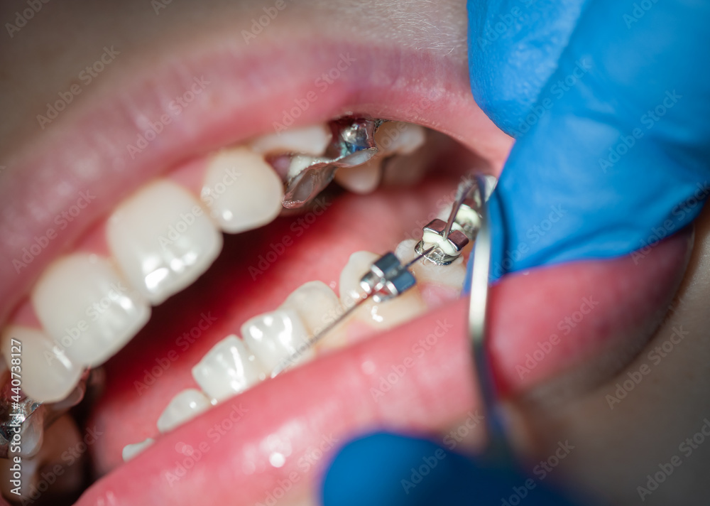 Installation of a metal arch and elastic bands for fixing on braces ...