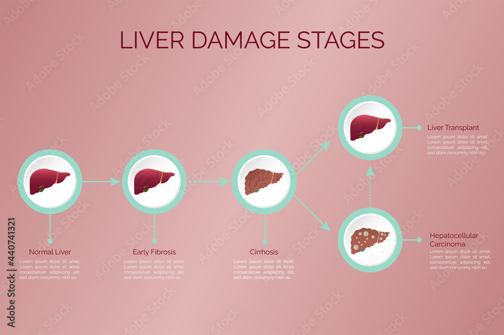 Infographic: stages of liver damage Stock Vector | Adobe Stock