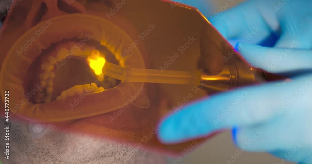 Close-up an Arabian male patient with optragate and ceramic braces on ...