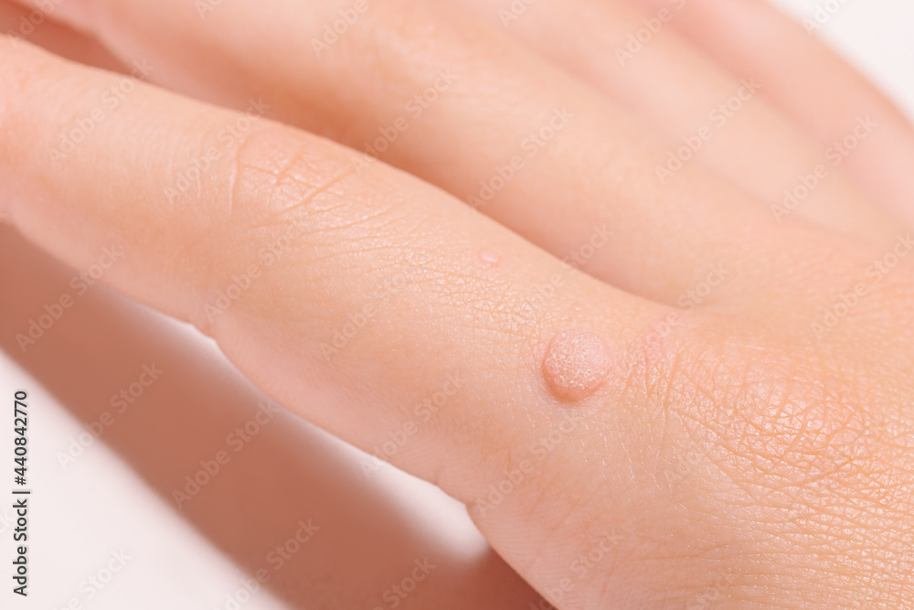 Common wart Verruca vulgaris a flat wart commonly found on the hand of ...