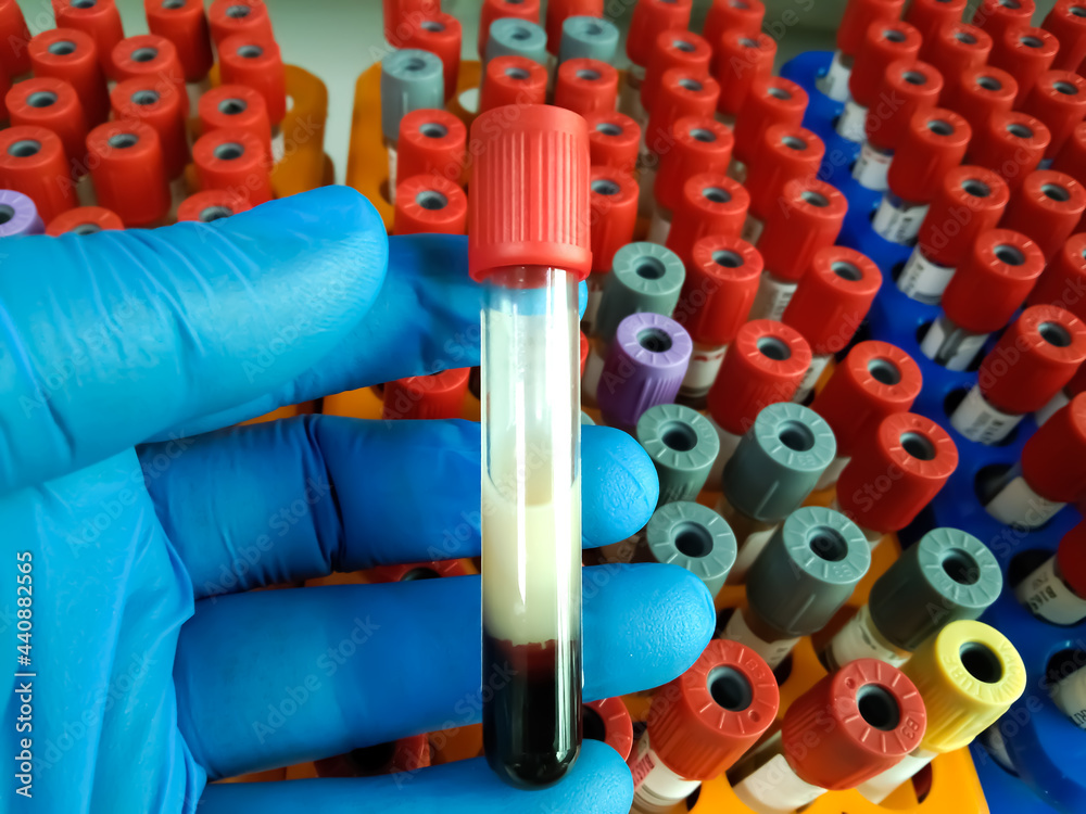 Scientist hold Lipemic blood sample, high Triglyceride contain serum ...