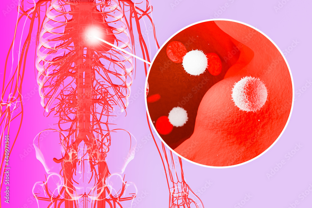 The walls of blood vessels are narrowed as a result of damage to the ...