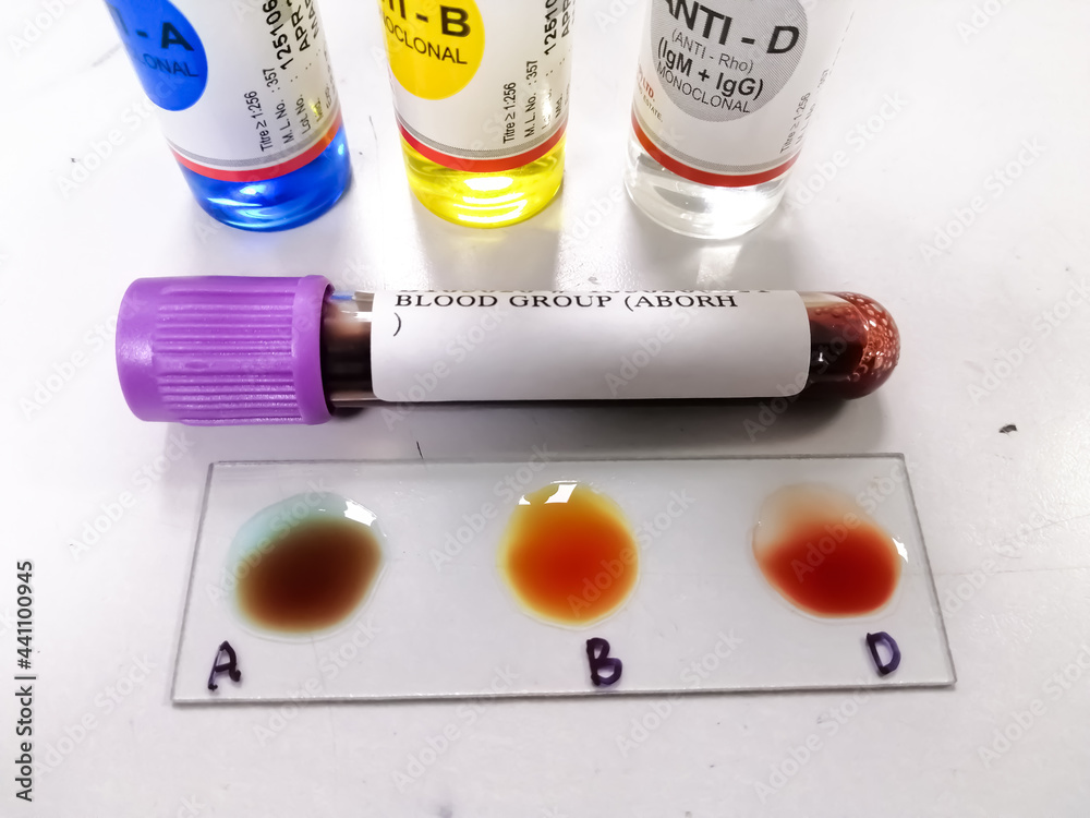 Blood group testing by slide agglutination method with sample and ...