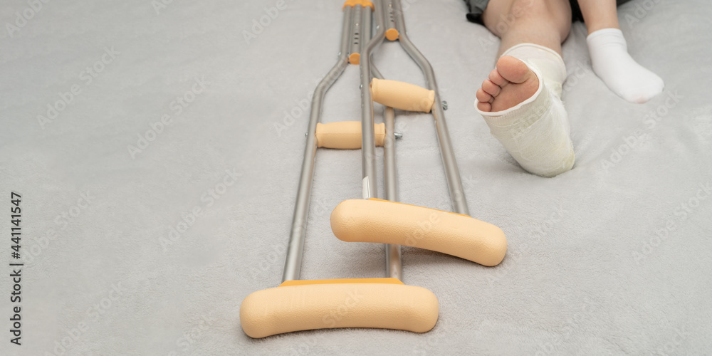 Fracture of the ankle bones in a female patient with a cast and ...