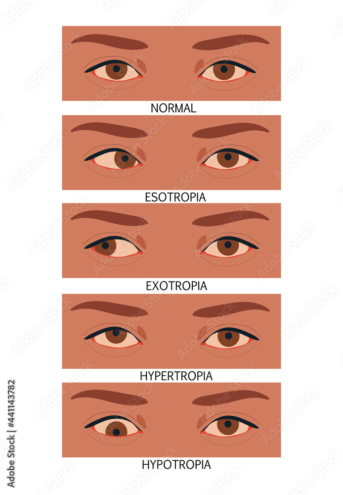 Types of Strabismus. Vector illustration in flat style. Stock Vector ...