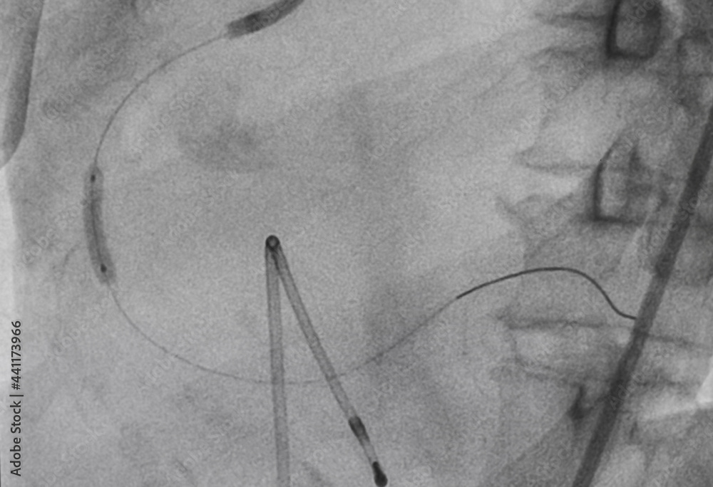 coronary artery angiography ,Coronary artery disease Stock Photo ...