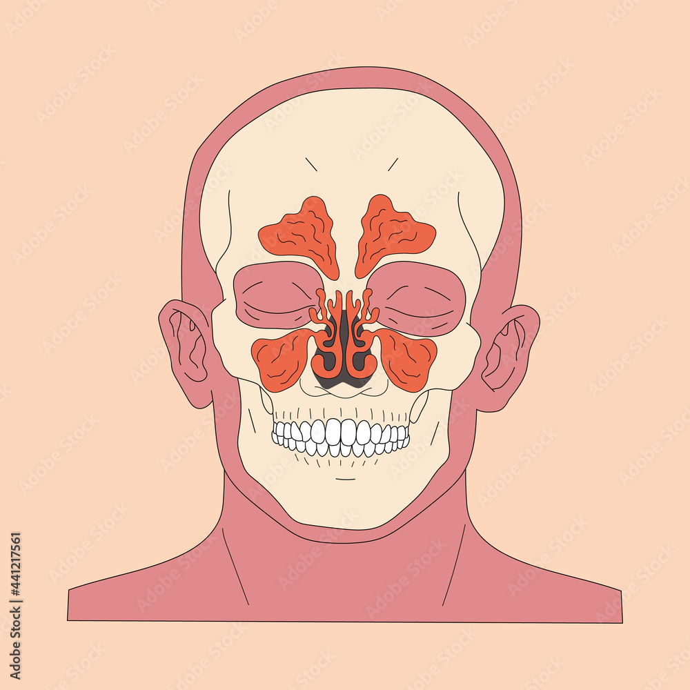Sinusitis, rhinosinusitis. Vector illustration in flat style. Stock ...