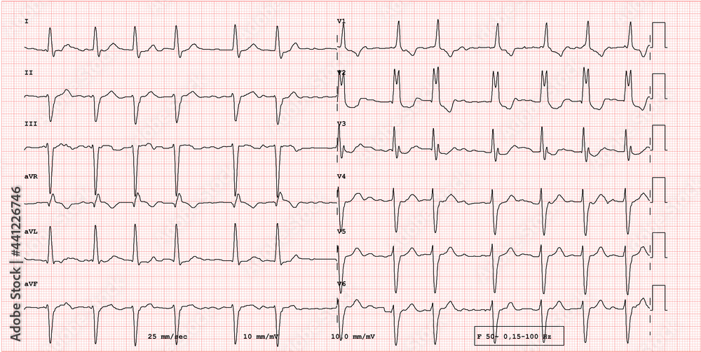 Poster Pathological 12-lead ECG, right branch block, left branch ...