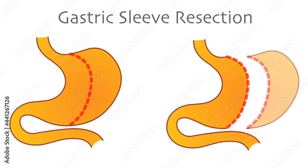 Gastric Sleeve Resection. Vertical stomach reduction bypass, operation ...