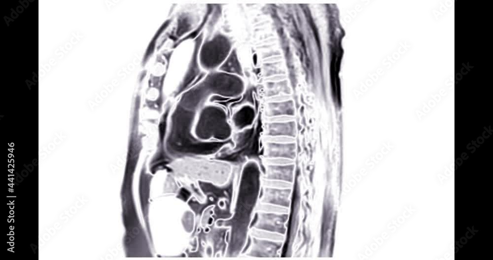 MRI heart or Cardiac MRI ( magnetic resonance imaging ) of heart in sagittal view showing heart ...